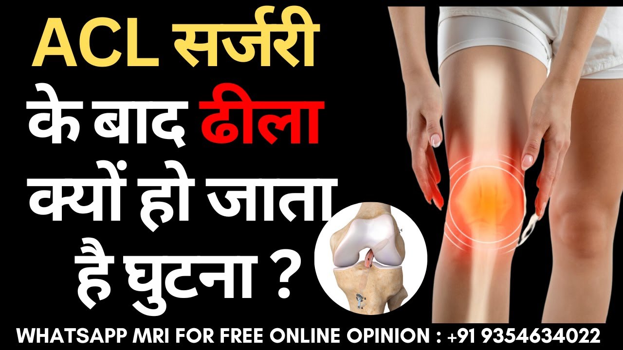#ACL सर्जरी के बाद ढीला क्यों हो जाता है घुटना ? Why Knee Get Loose ...