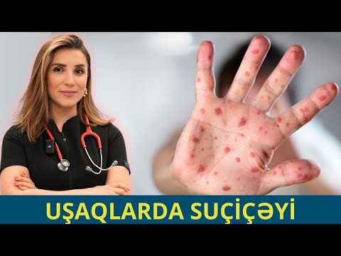SUÇİÇƏYİ xəstəliyi zamanı DƏRİYƏ QULLUQ - NƏLƏRİ ETMƏK OLMAZ?! | Pediatr Aytən Ziyadova