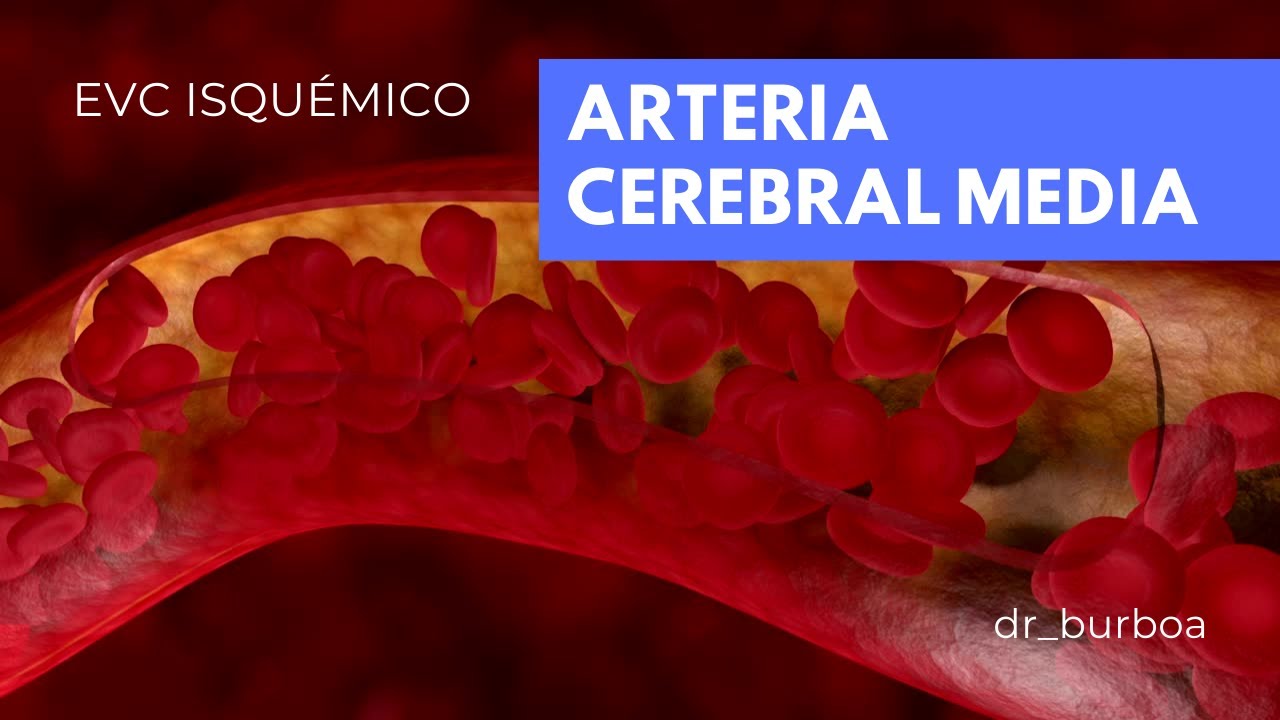 EVC ISQUÉMICO ARTERIA CEREBRAL MEDIA - YouTube