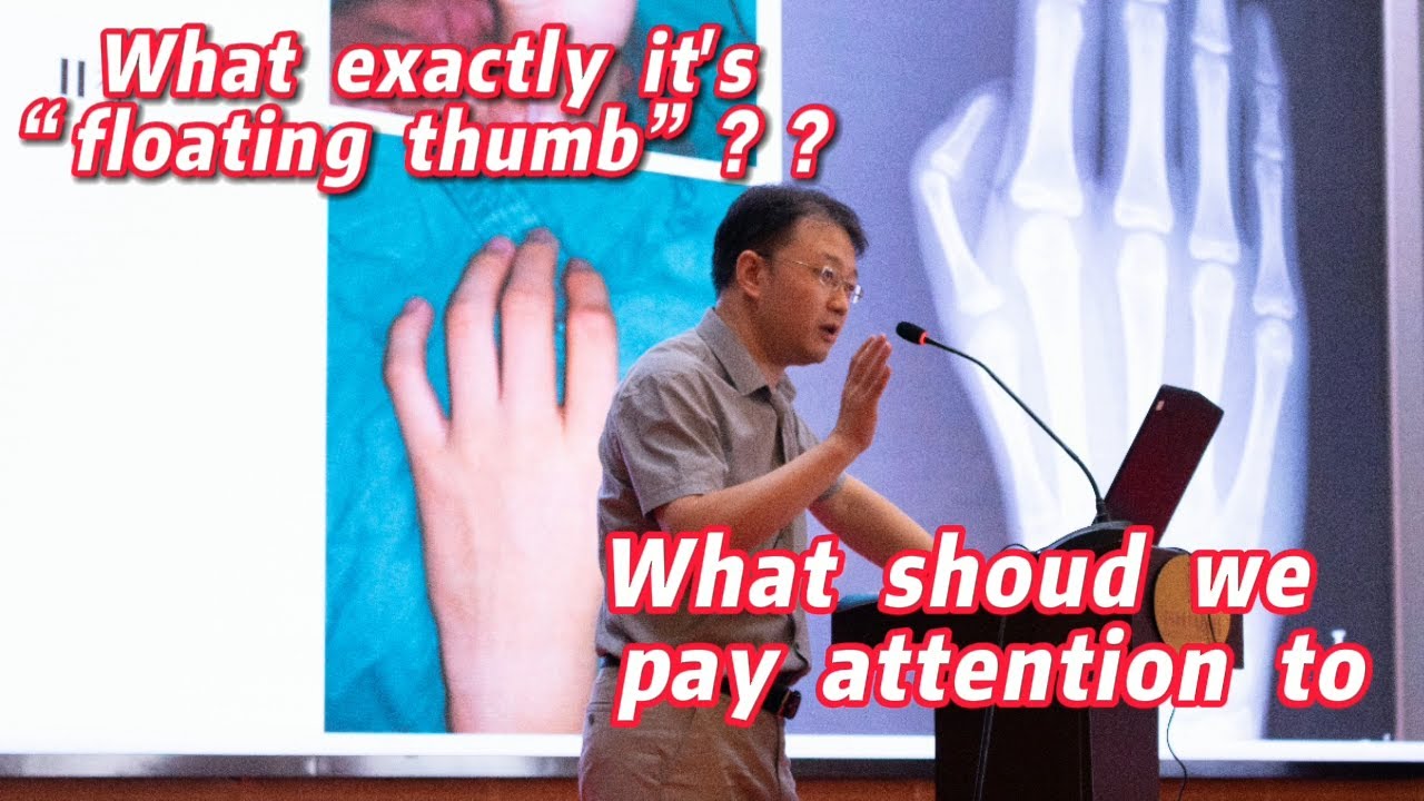 What exactly it’s "floating thumb"?(thumb hypoplasia) - YouTube