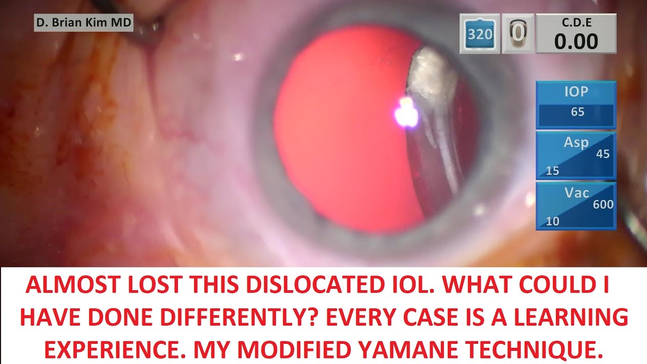 Almost Lost this Dislocated IOL. What Could I Have Done Differently? My ...