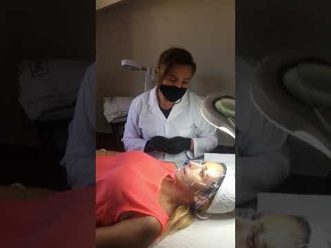 AKNE SCAR TEDAVİSİ