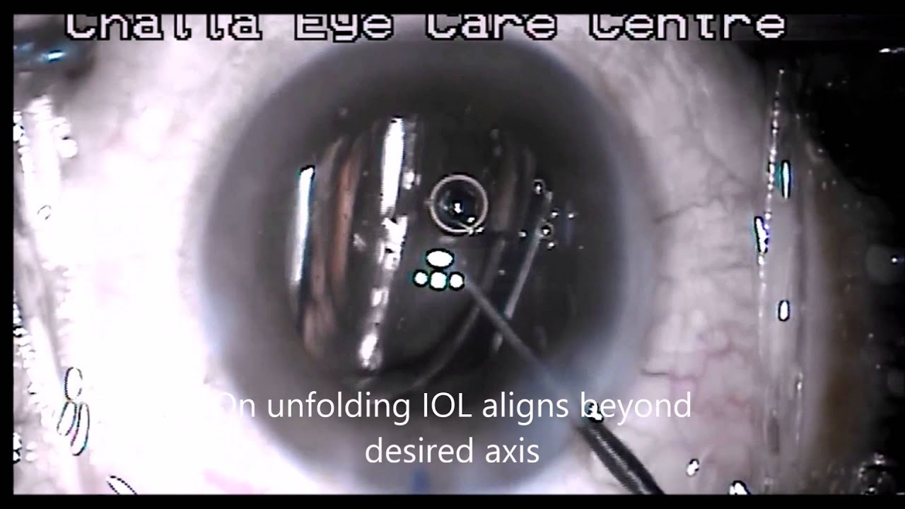 Toric Multifocal IOL Implantation - YouTube