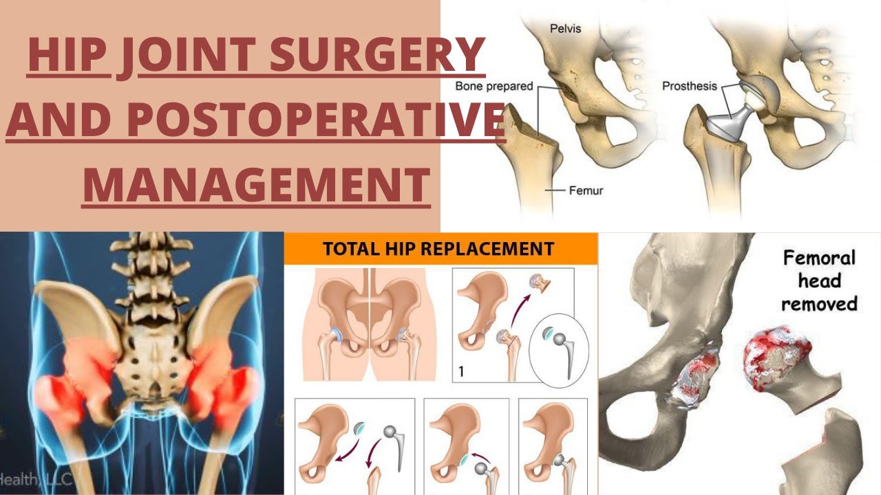 HIP JOINT SURGERY AND POSTOPERATIVE MANAGEMENT||Total Hip Arthroplasty ...