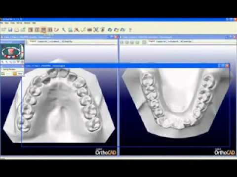 スタディモデル OrthoCAD Study Model - YouTube