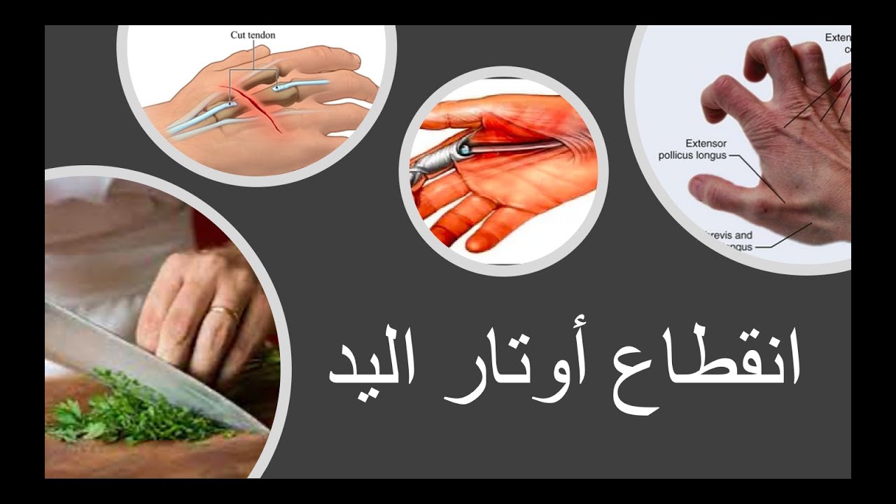Tendon cut repair / انقطاع أوتار اليد العضلية وعلاجها - YouTube