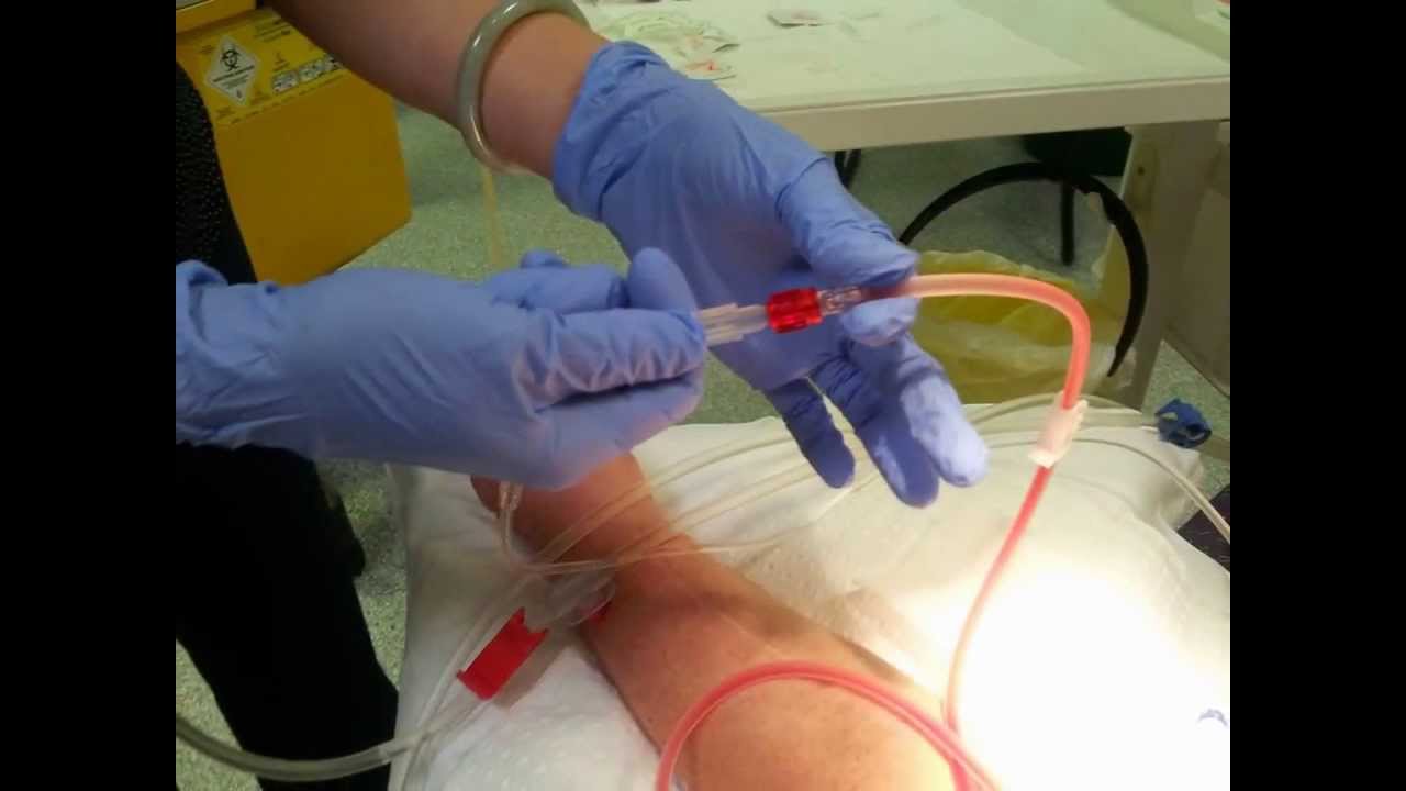 Cannulate, connecting and commencement of haemodialysis - YouTube