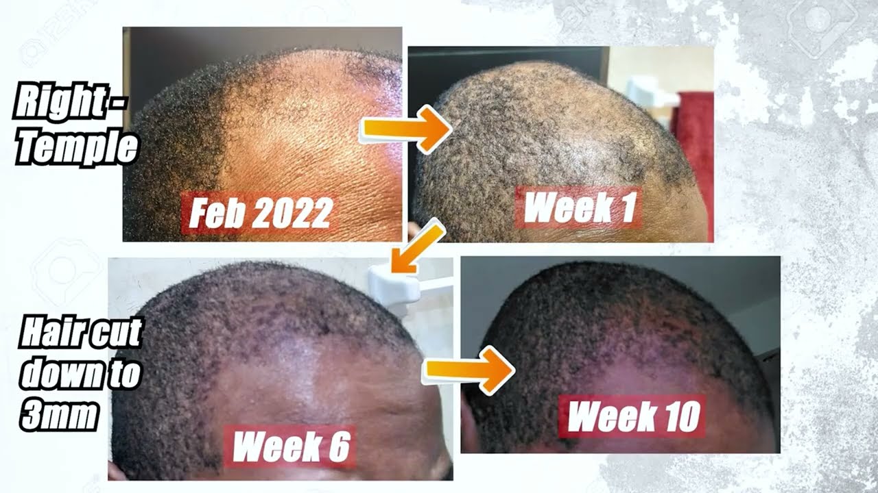 Signs My Derma Rolling WORKED - YouTube