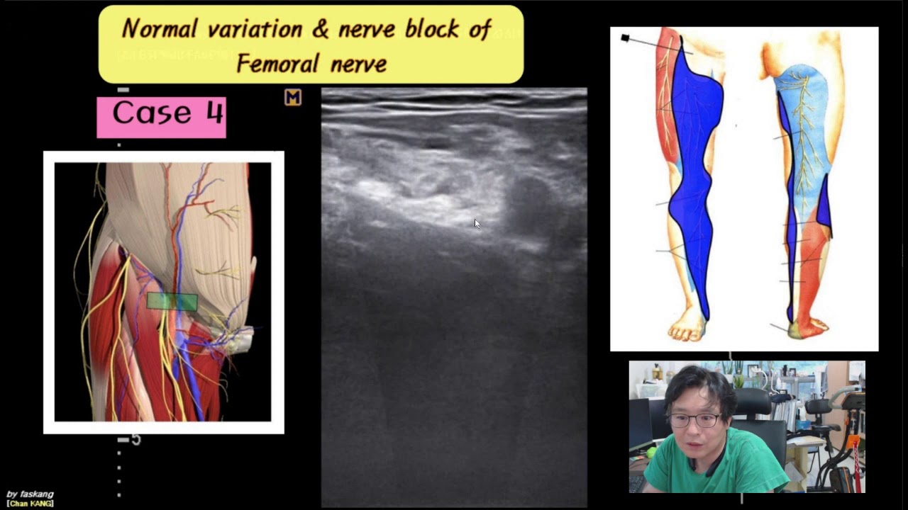 419.(의사용. Nerve block) Case4,5,. Normal variation & NB of femoral nerve ...