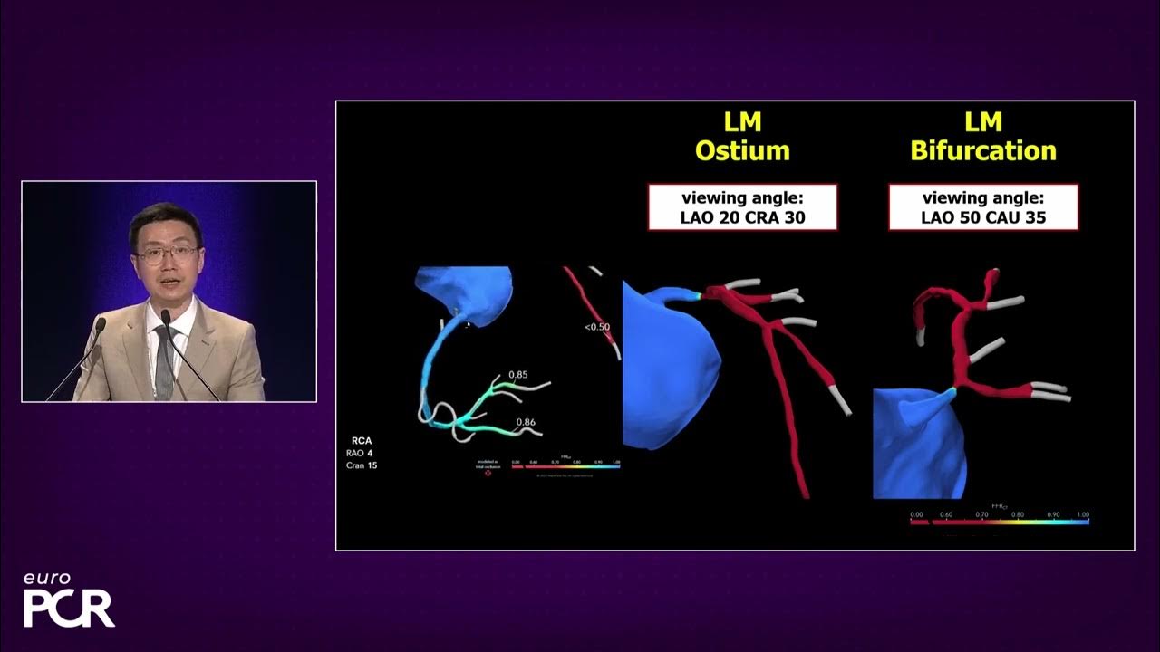 Left main bifurcation treatment with Supraflex Cruz stent - YouTube