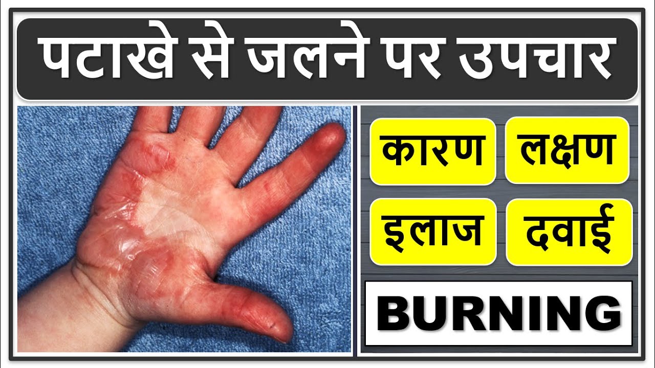 पटाखे से जलने पर उपचार, कारण, लक्षण, इलाज, दवाई, Treatment of Burning ...