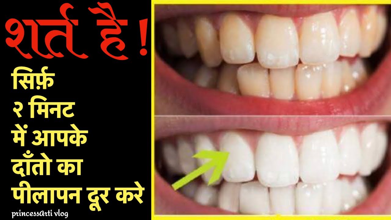 Teeth Whitening At Home In 2 Minutes || How To Whiten Your Yellow Teeth ...