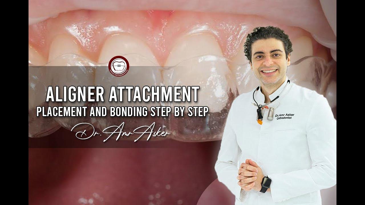 Aligner attachment placement and bonding step by step- aligner delivery -invisalign - YouTube