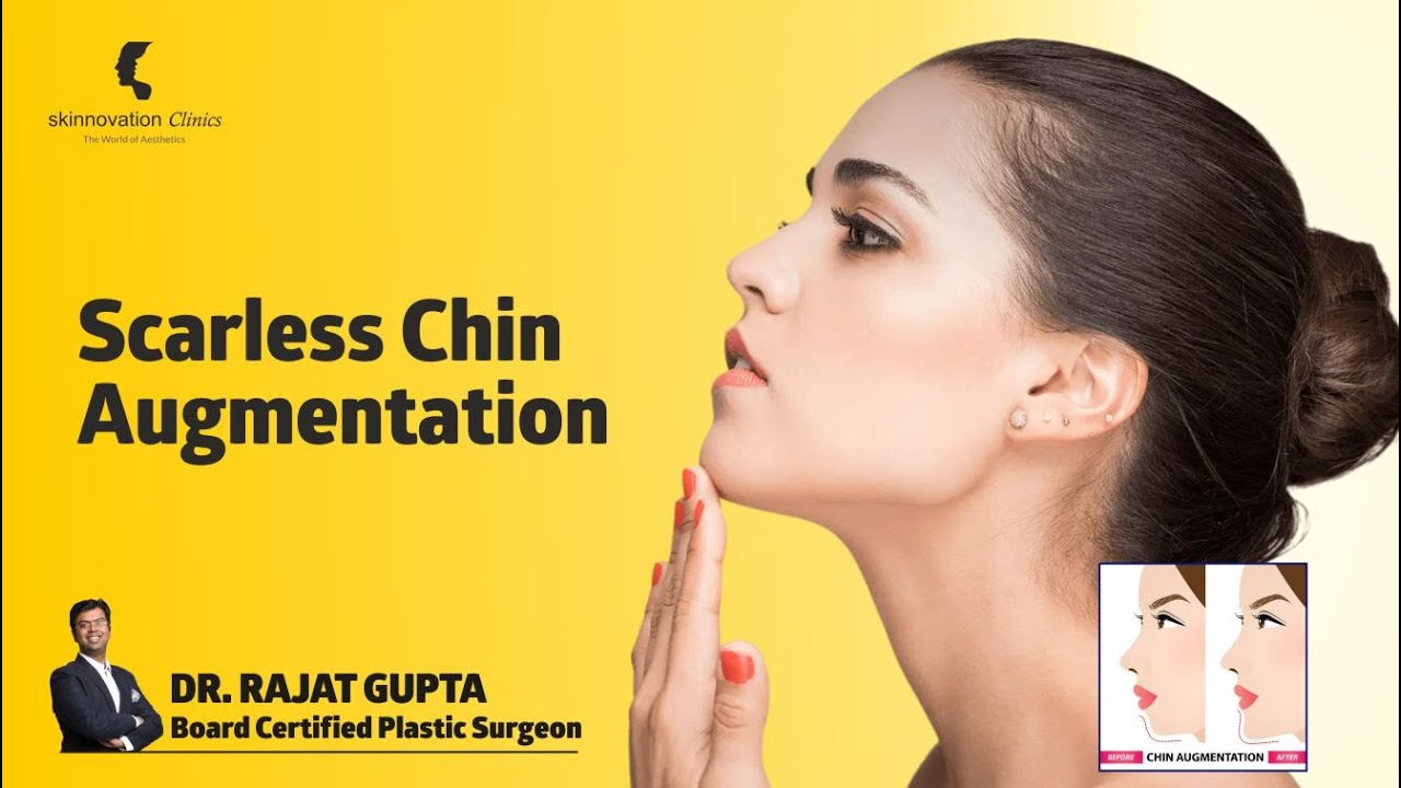 Scarless Chin Augmentation | Chin implant surgery in India | Dr Rajat ...