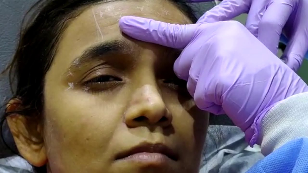 Fix Heavy, Droopy Eyelids | BOTOX Treatment - YouTube