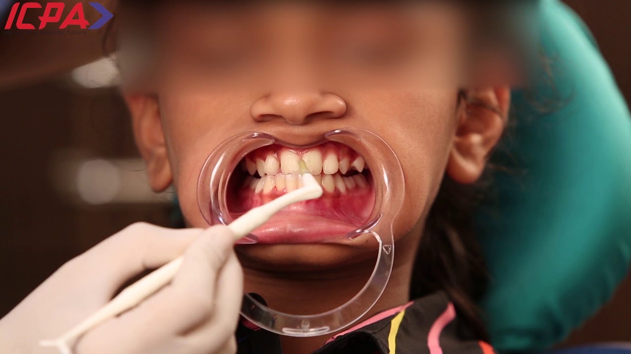 The Best Technique to Apply Fluoritop Varnish in Children - YouTube