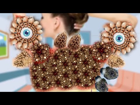 Asmr Maggot, Dog Ticks Removel | ASMR 2D Treatment Animation | - YouTube