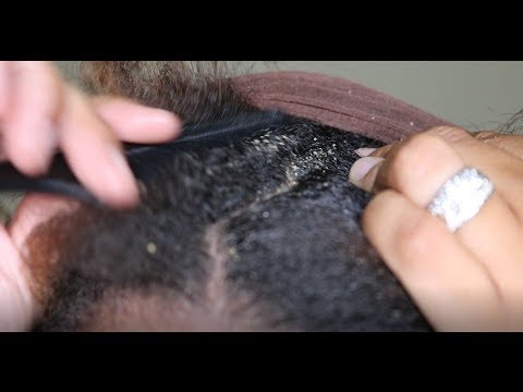 Late Night Dandruff Scratching; Pt. 2 of 3 - YouTube
