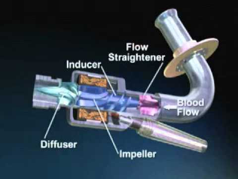 Inside the HeartAssist 5® VAD - YouTube