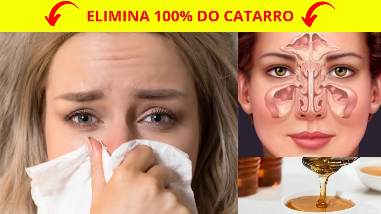 Xarope Para Eliminar Catarro Pelas Fezes Rápido e Natural - YouTube