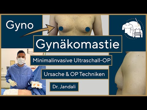 Endlich wieder flache Brust! Gynäkomastie (Gyno) erkennen & behandeln – alle Optionen erklärt ✅👨‍⚕️