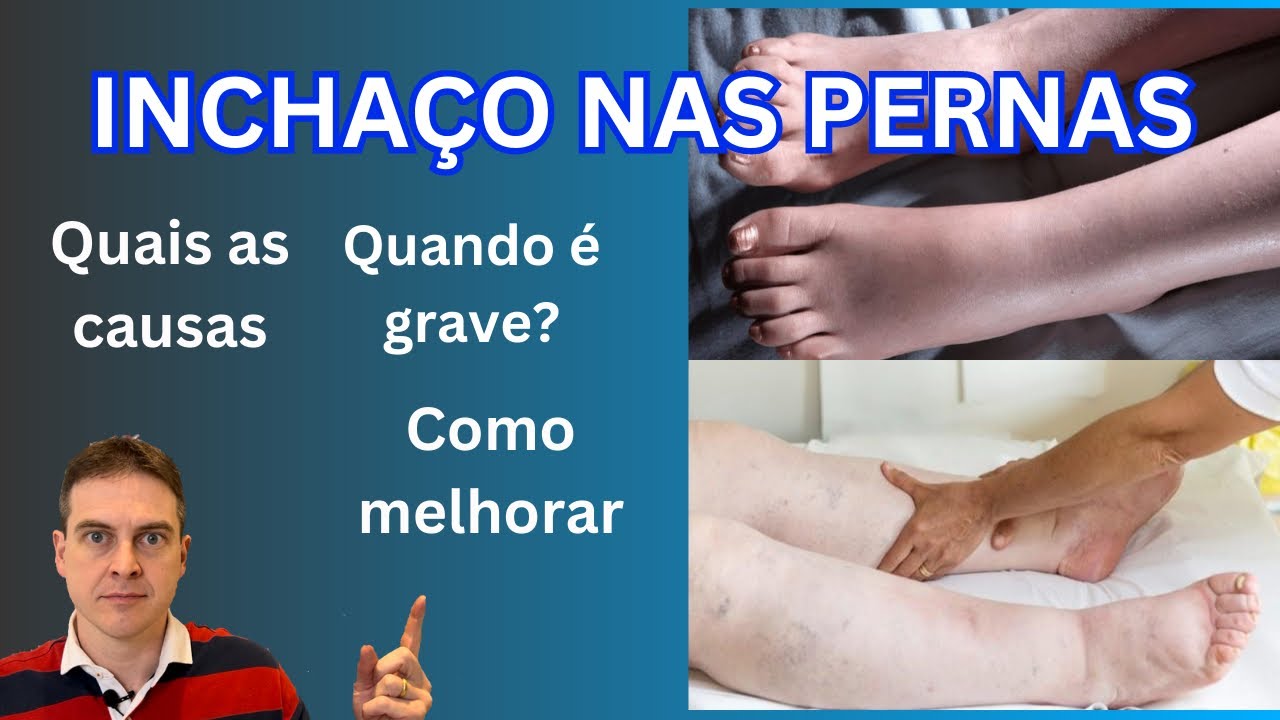 INCHAÇO NAS PERNAS - COMO MELHORAR - Porque ocorre? SAIBA SE O INCHAÇO ...