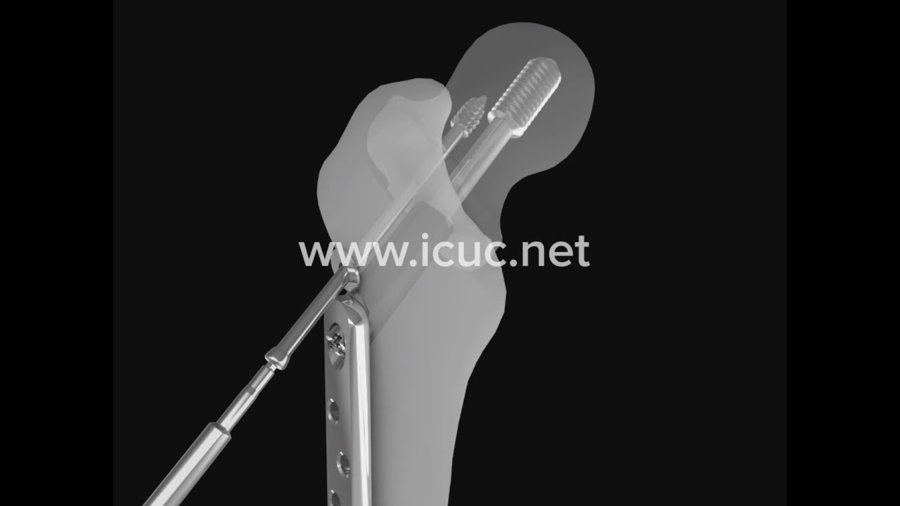 Proximal Femur Tip and Trick on the use of Trochanter Stabilization ...