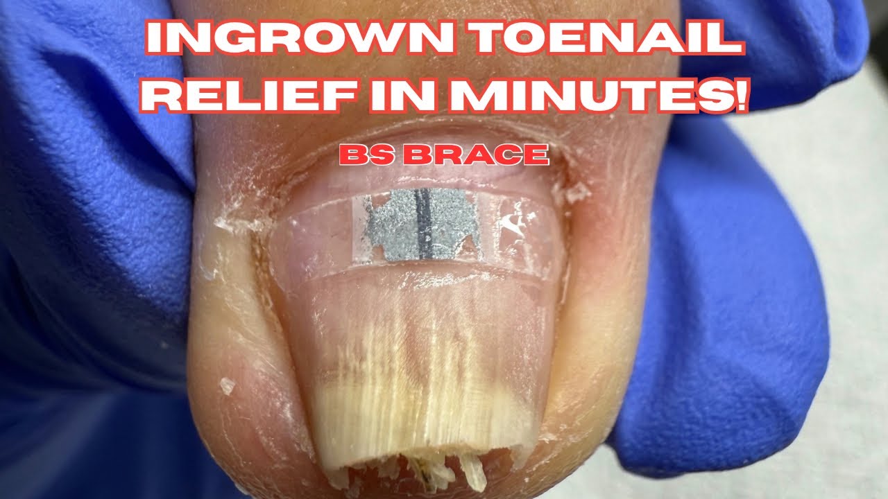Soakless Pedicure + BS Brace Application for Ingrown Toenail Relief ...