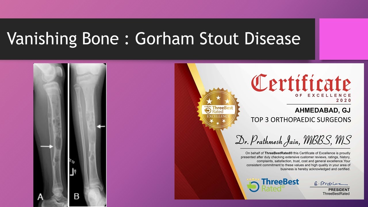 Gorham's Stout Disease : Vanishing Bone Disease (Lymph Vessels into ...