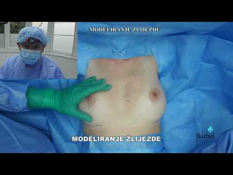 Vađenje implantata iz grudi zbog straha od ALCL / Breast Implant Removal Because of ALCL Fear