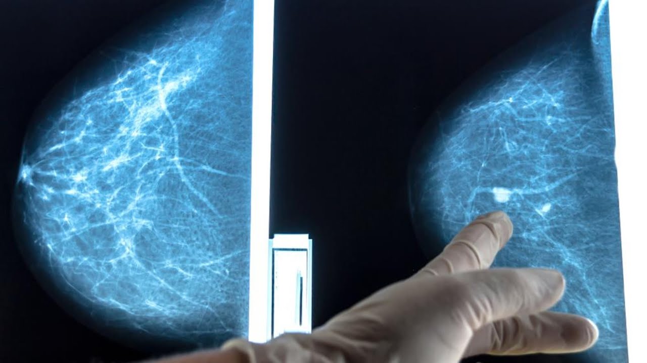 ASSESSMENT & DIAGNOSTICS 104: Hyperplasia of the Breast, Heart Yang ...