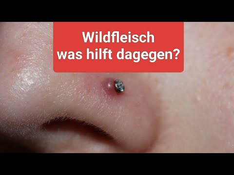 Wildfleisch am Piercing wir sagen dir was du dagegen tun kannst, und ...