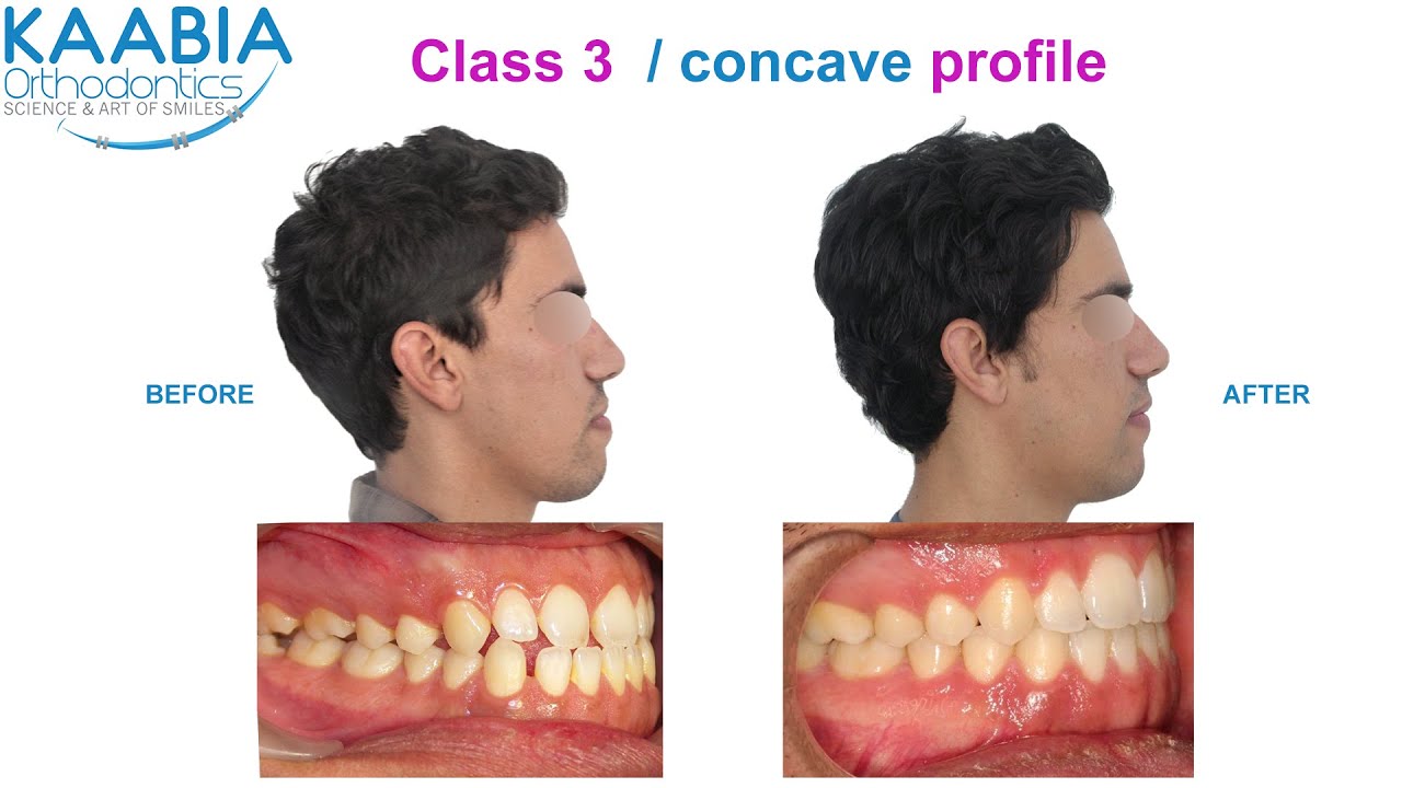 Class 3/anterior cross bite/concave profile.Classe 3/occulusion ...