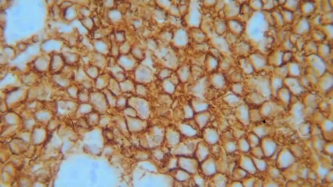 03 CD20 positive staining B cell origin - YouTube