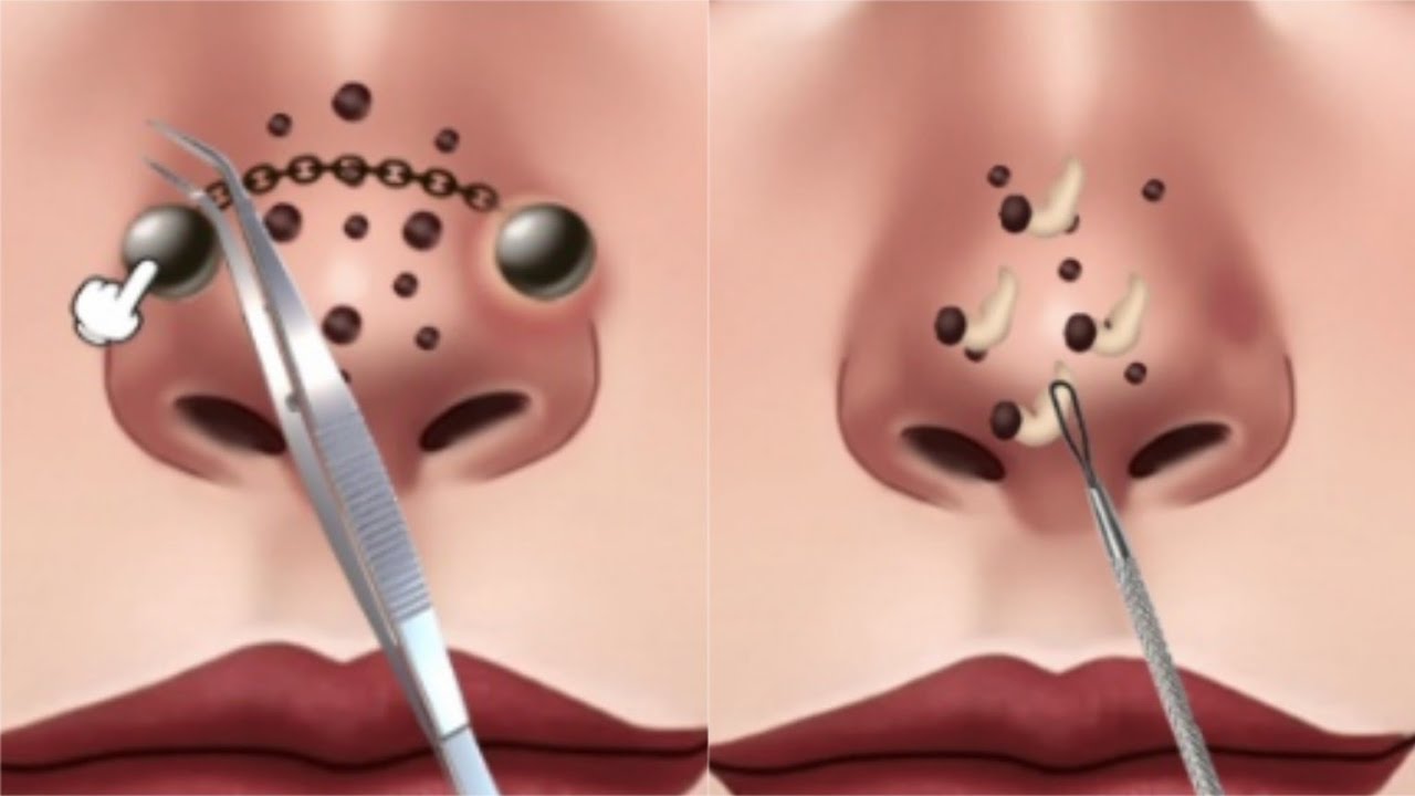 asmr Animation NOSE Piercing Infaction Remove Deep Cleaning - YouTube