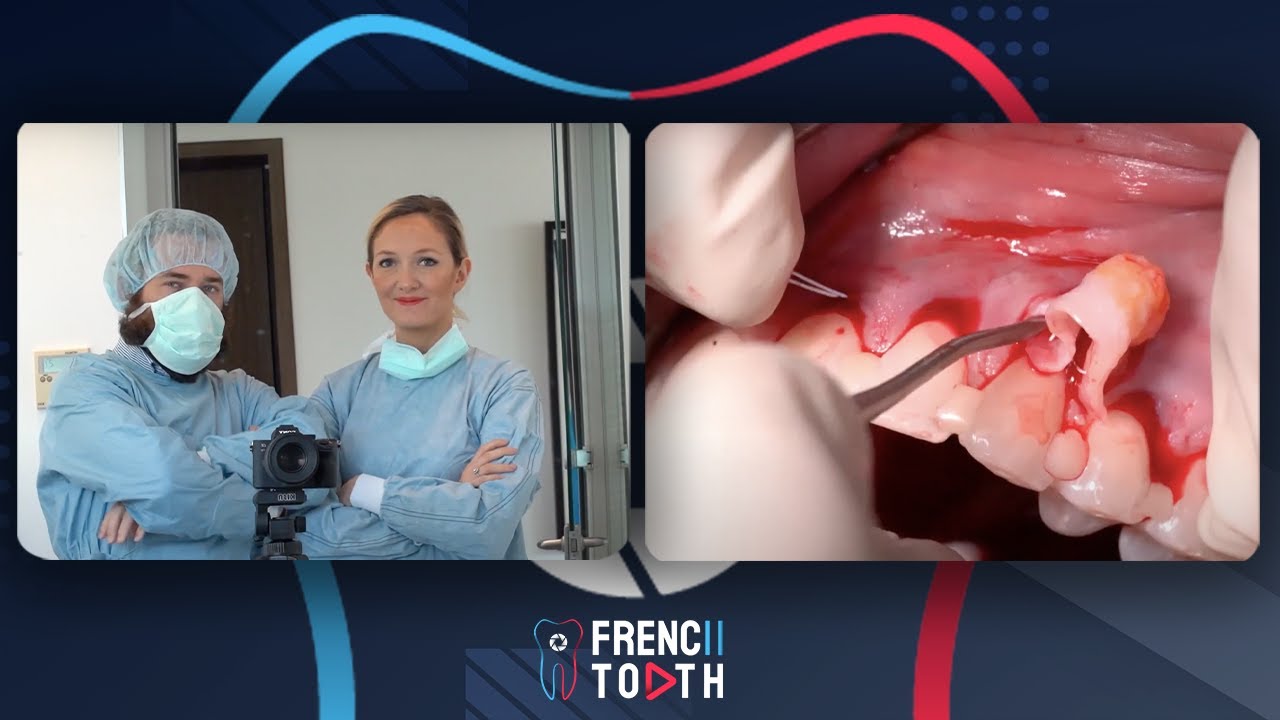 FRENCH TOOTH : On vous en dit plus sur notre concept ! - YouTube