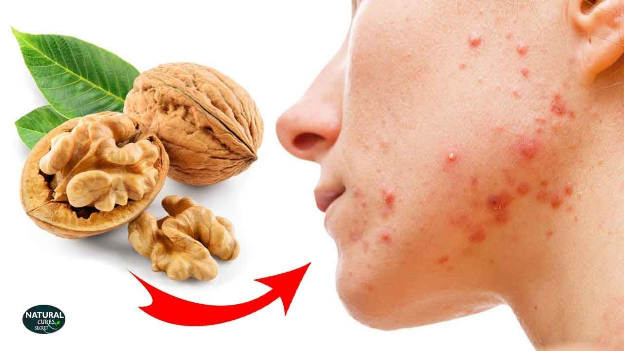 6 Foods That Destroy Your Skin According To Dermatologist - YouTube