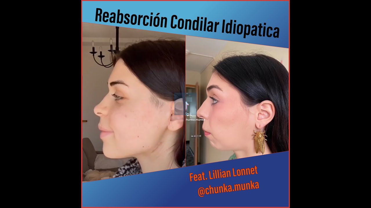 Reabsorción Condilar Idiopatica. ¿Qué es y como se trata? - YouTube