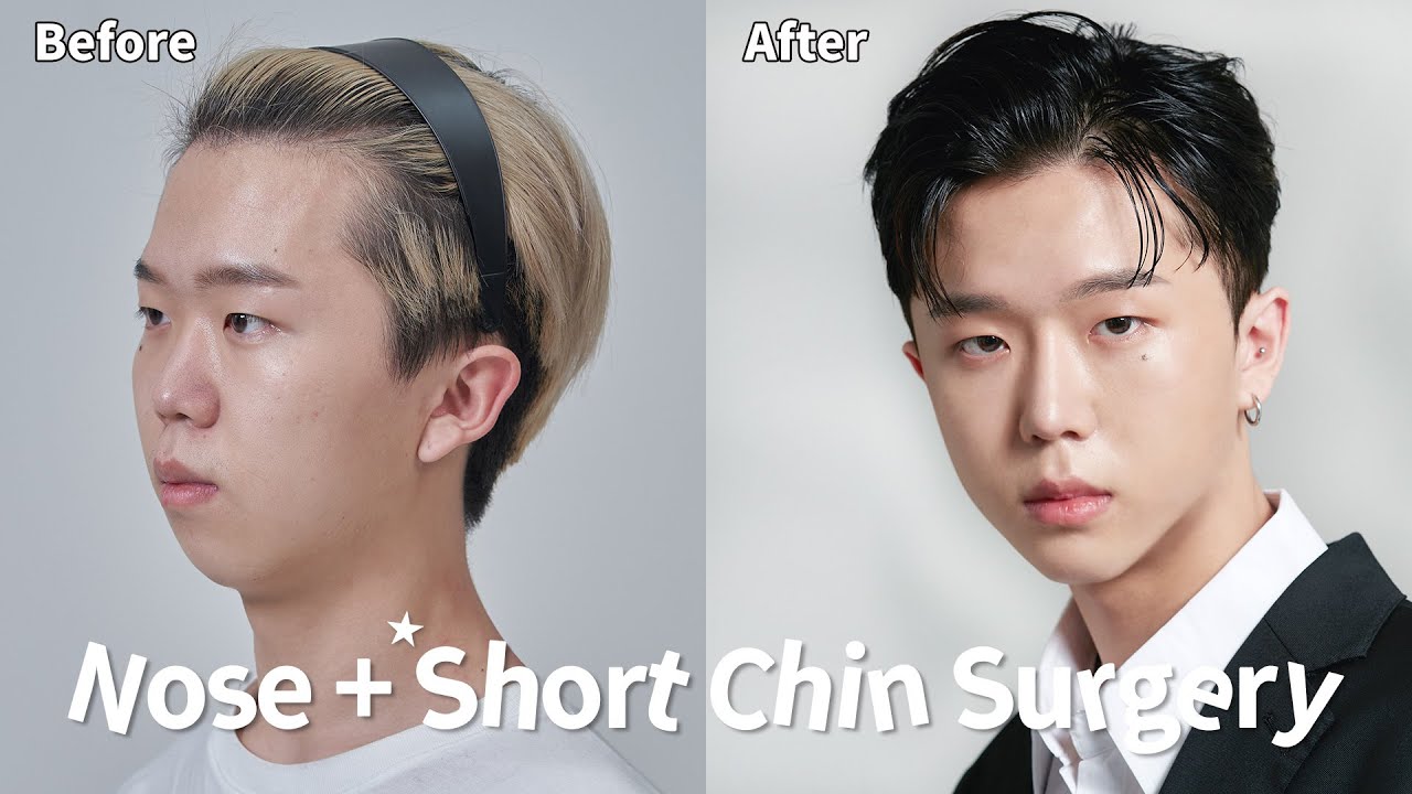 Male Rhinoplasty and Short Chin Correction with Implant at Girin ...