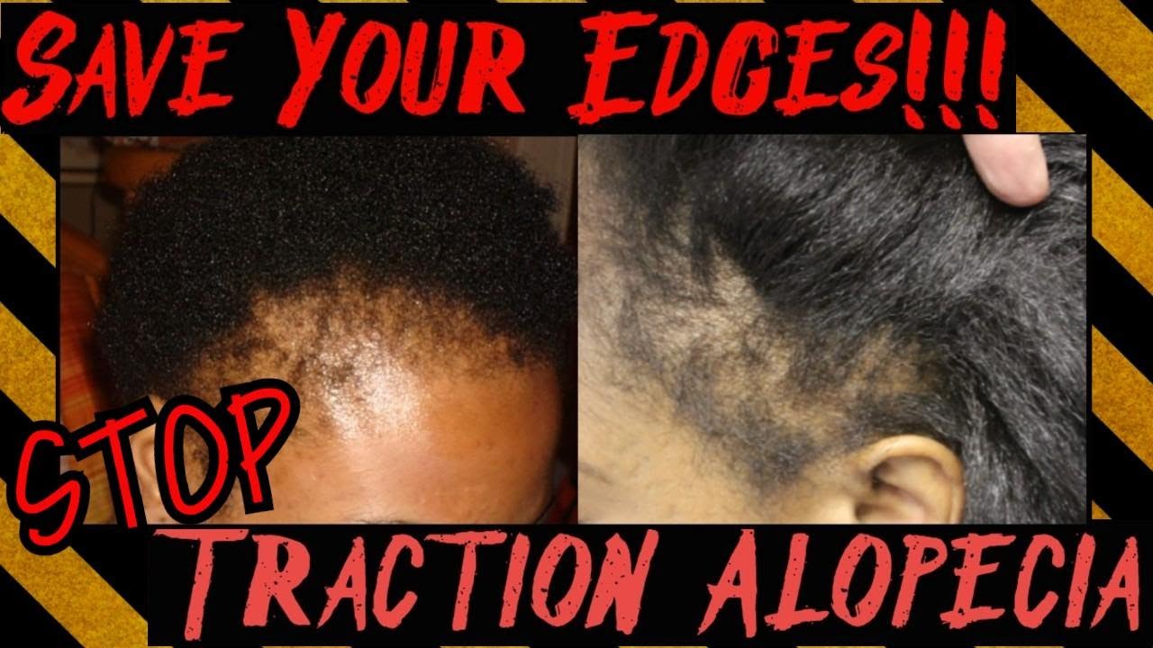 How To Grow Edges Fast - Reverse Traction Alopecia - YouTube