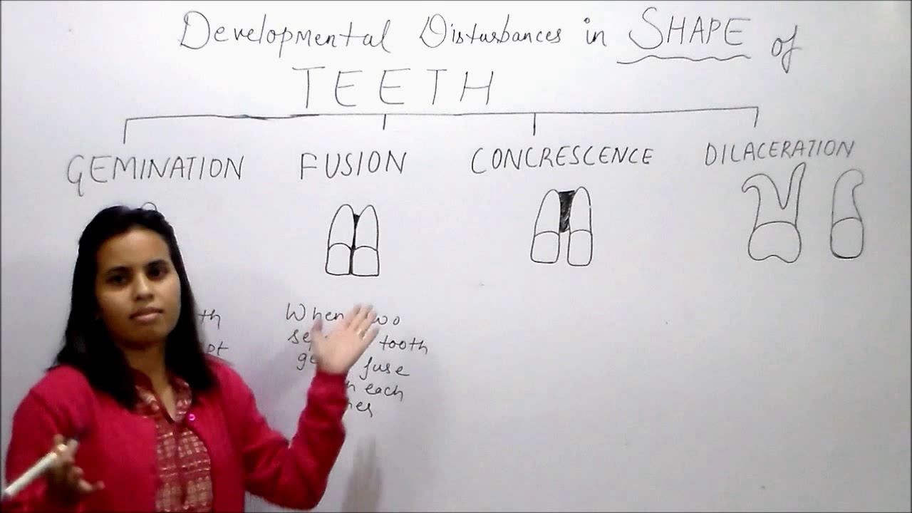 fusion Developmental tooth anomaly By Dr Prerna Shrivastava career Hub ...