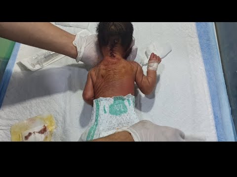 TitlesNewborn Baby in NICU | MMC Surgery Recovery After DressingTiny ...