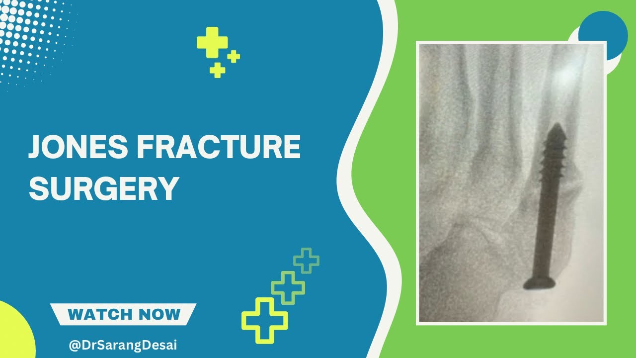 Intramedullary Screw Fixation of Chronic Jones Fracture with Arthrex ...