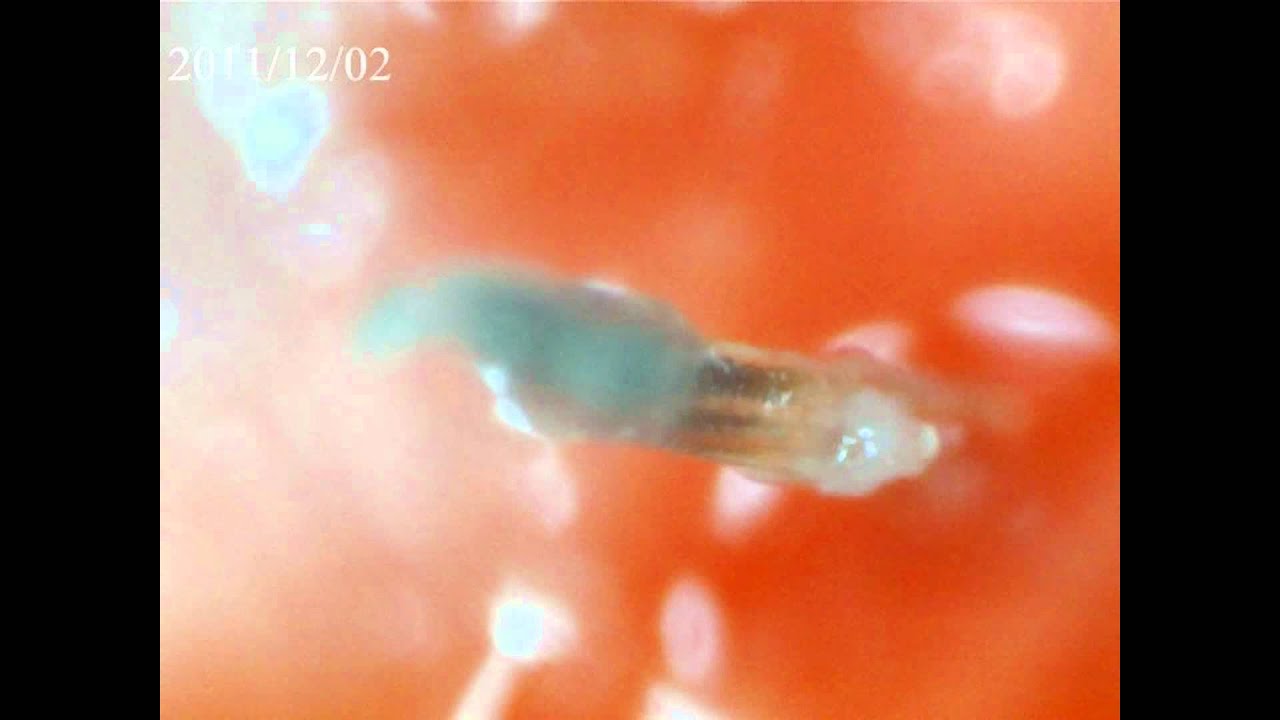 BUGS ! or Blackheads MORGELLONS - YouTube