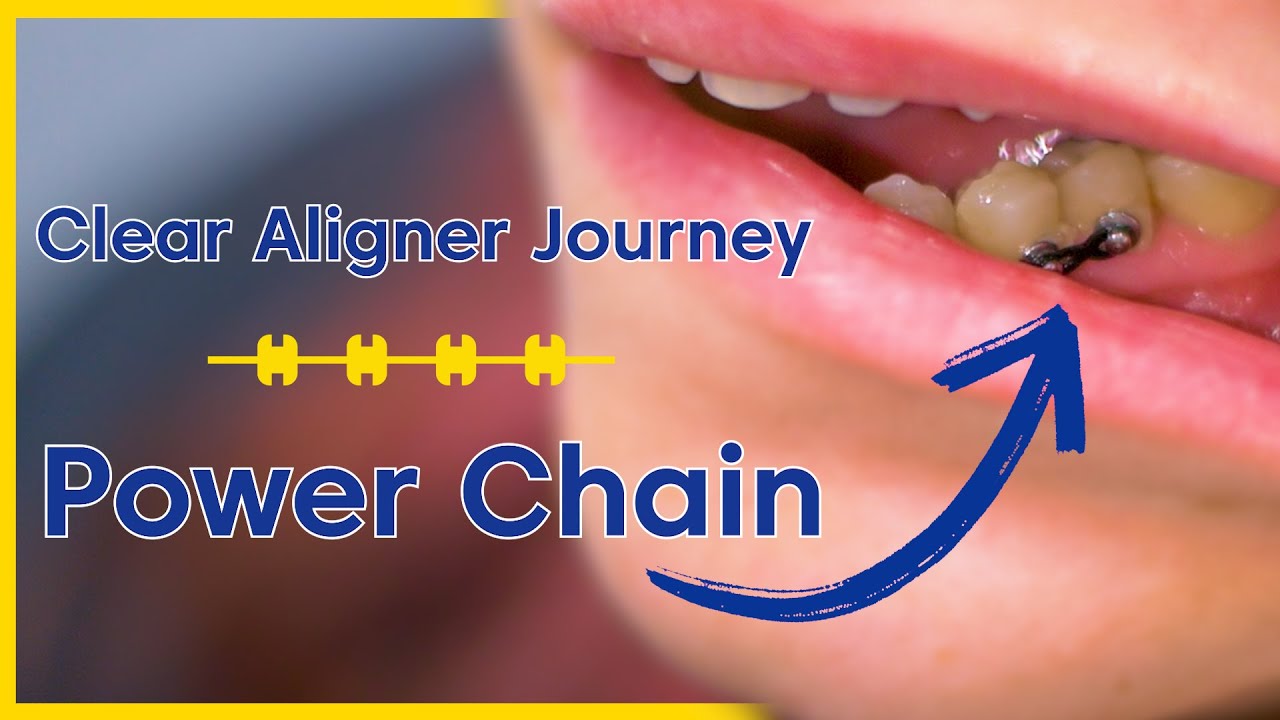 Power Chains: The Clear Aligner Secret You Didn't Know About - YouTube
