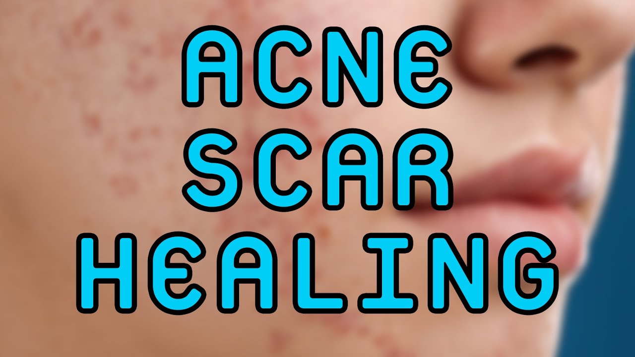 Cystic Acne Scar Healing Subliminal - Pitting Scars - Hypertrophic ...