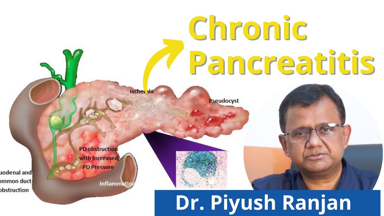 😣 Chronic Pancreatitis: Causes, Symptoms, Diagnosis and Treatment in ...
