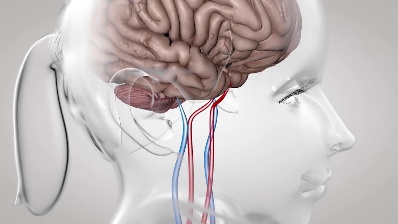 Qué es la parálisis cerebral diplejía espástica - YouTube