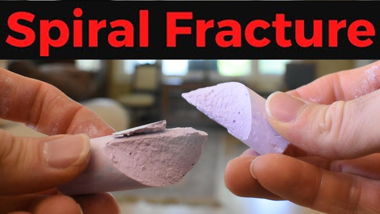 Chalk SPIRAL Fracture! EXPLAINED!!! - YouTube