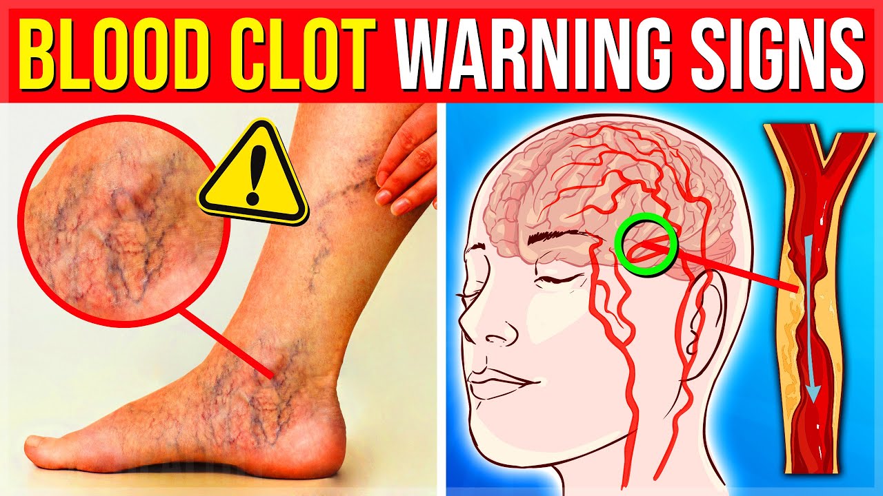 10 Blood Clots WARNING Signs You Must Never Ignore! - YouTube